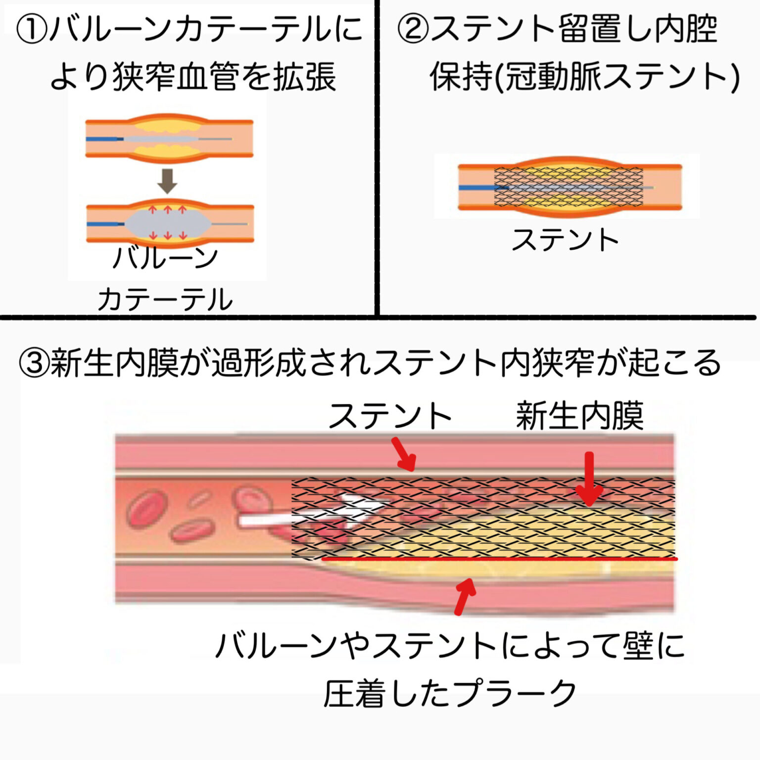 ステント内再狭窄因子, ステント 再狭窄 メカニズム _ DCBによる治療後のステント内再狭窄再発の予測因子 – KRCTV